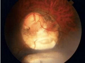 COLOBOMA – SBOP – Área do Paciente