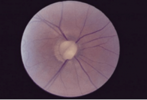 COLOBOMA – SBOP – Área do Paciente